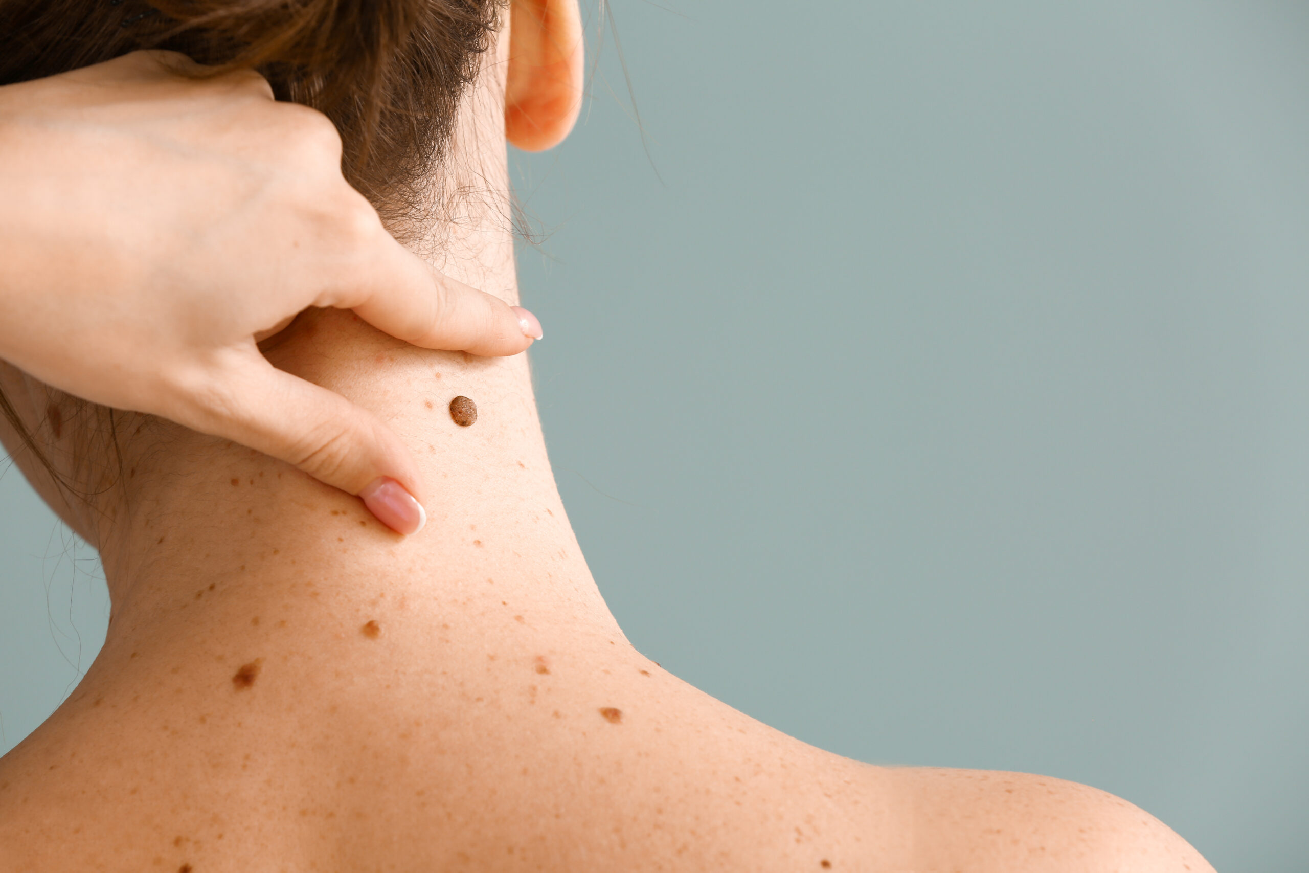 Moles North Pacific Dermatology Dermatology